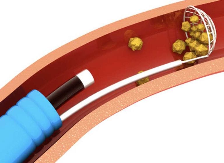 Ureteroscopy - UCI Urology | Kidney Stone Center | Kidney Stone ...